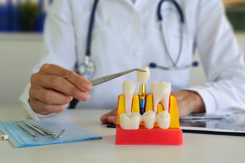 How to Care for Your Dental Implants for Long-Term Success